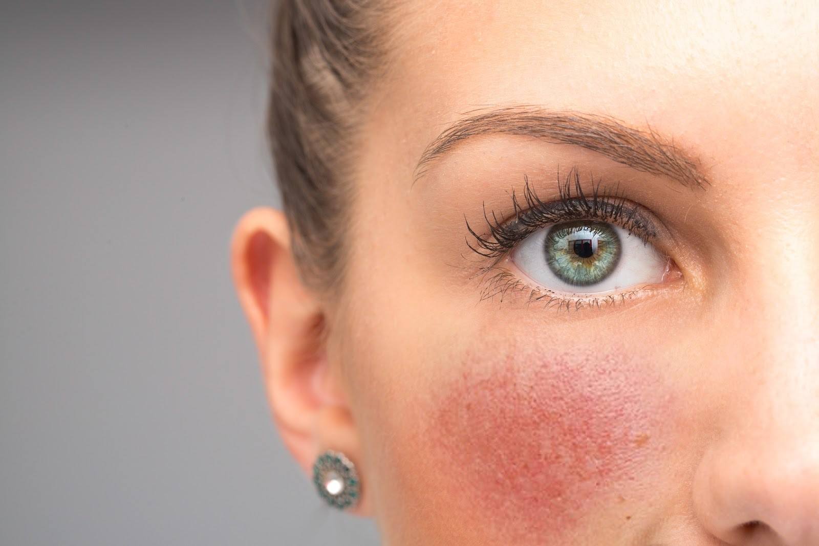Rosazea - Gesundheitsreport.com